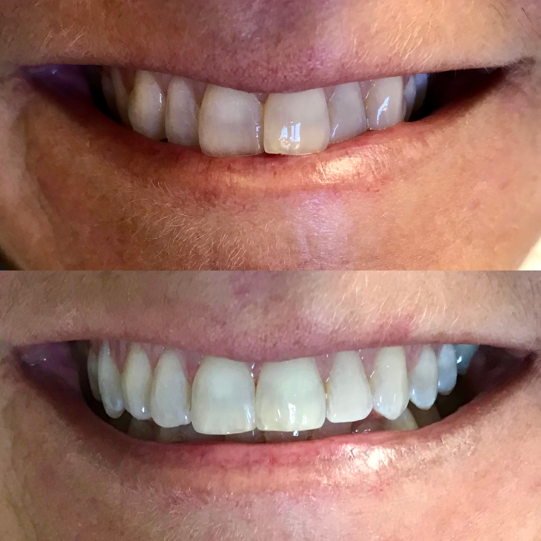 Before and Afters – Invisalign