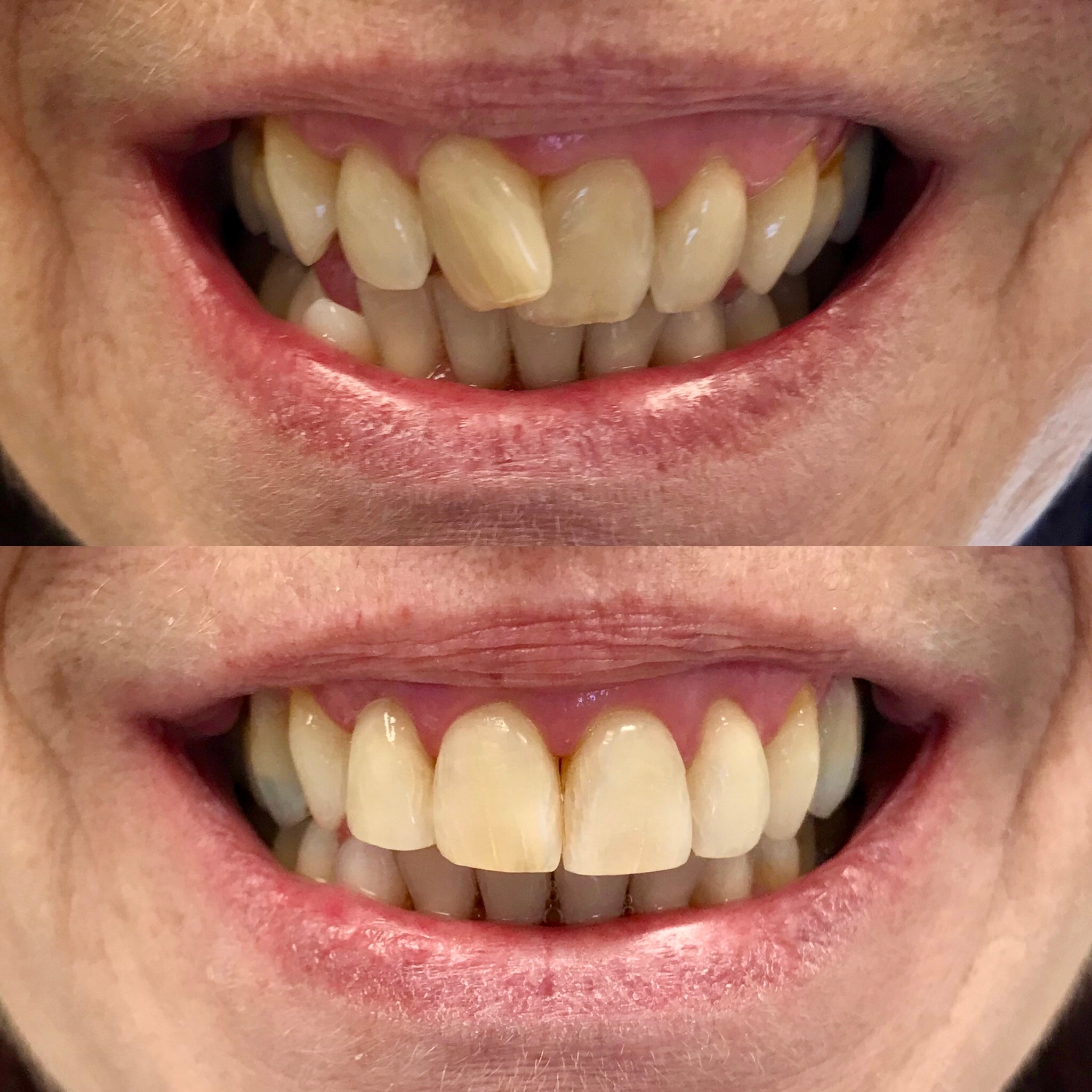Before and Afters – Invisalign
